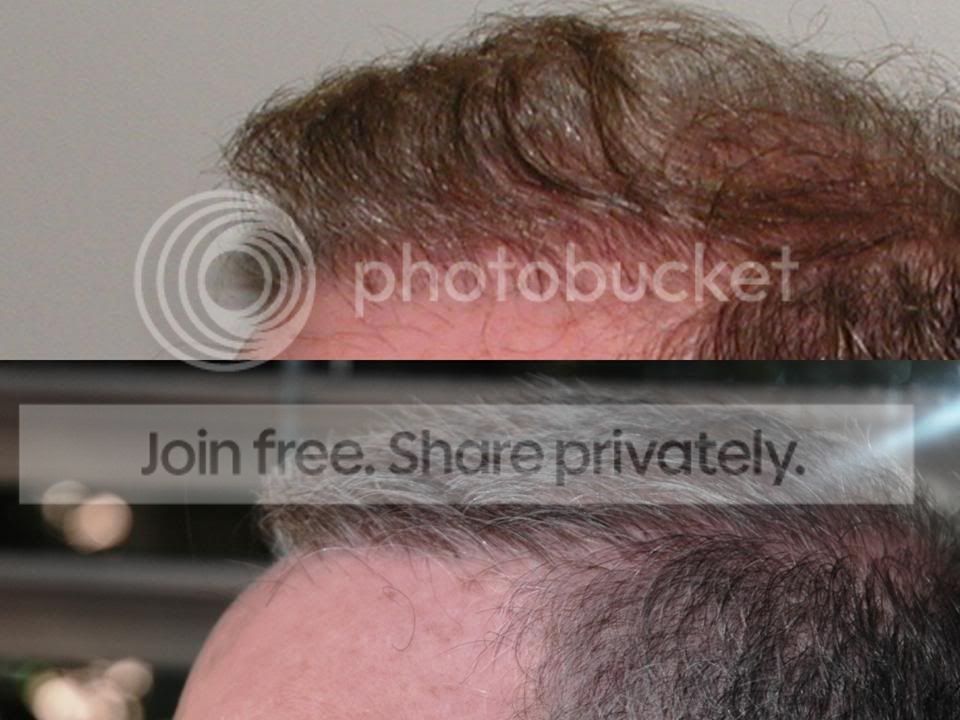 Revision of bad hair transplant - Hair Restoration Questions and ...